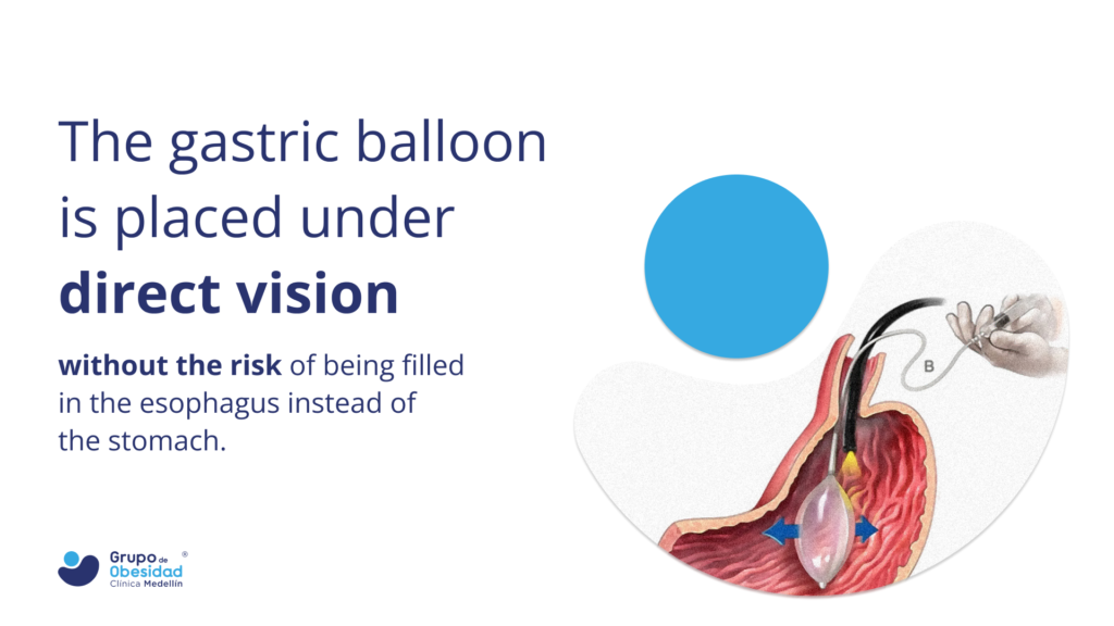 The Gastric Balloon Placed via Endoscopy